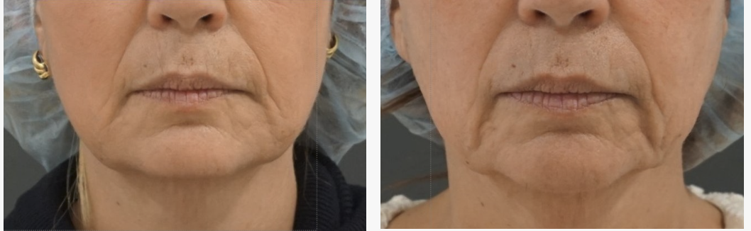 Sofwave - Ageless Anatomy Med Spa